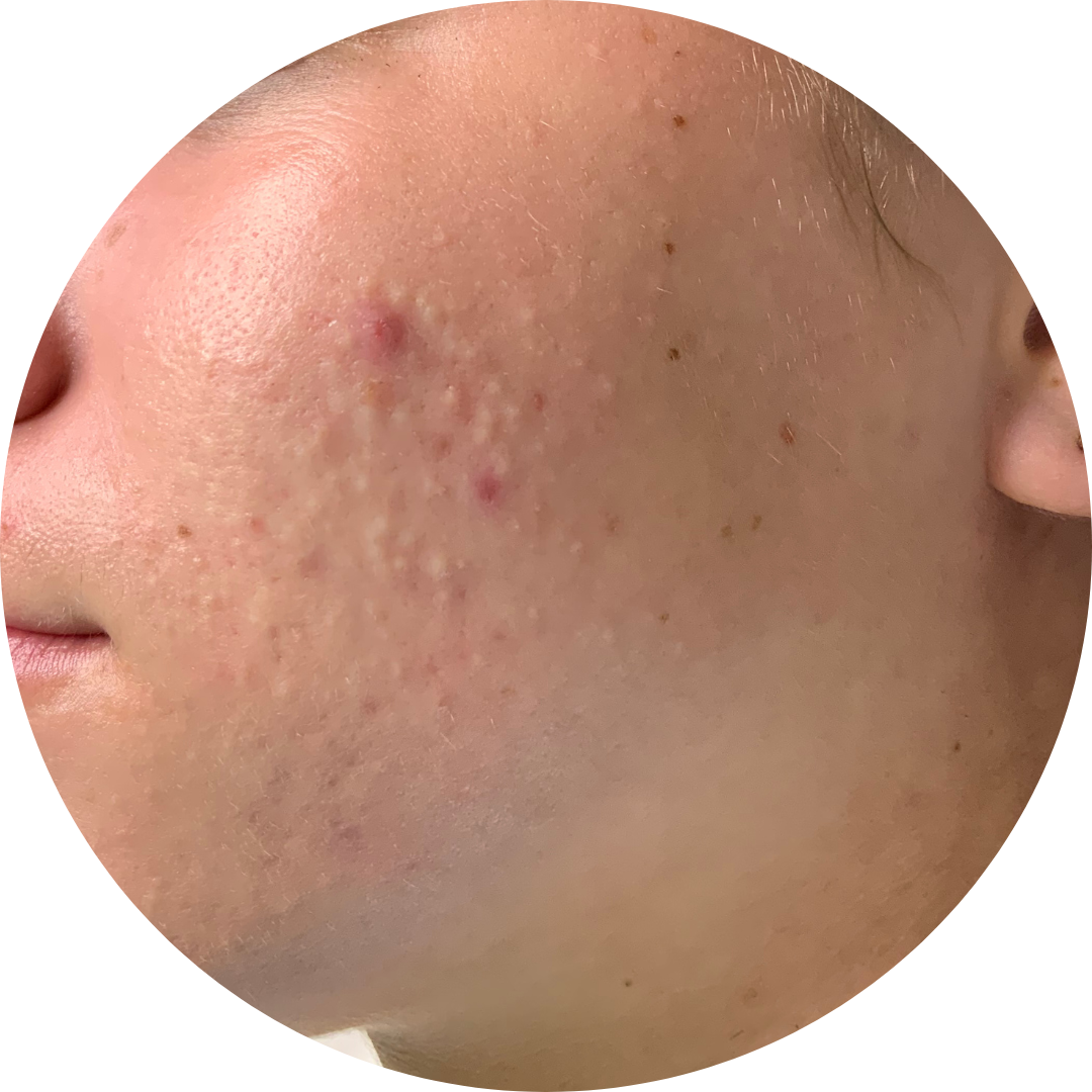 Acne Type 2 | Non-Inflamed Maturation Arrest – Skin+
