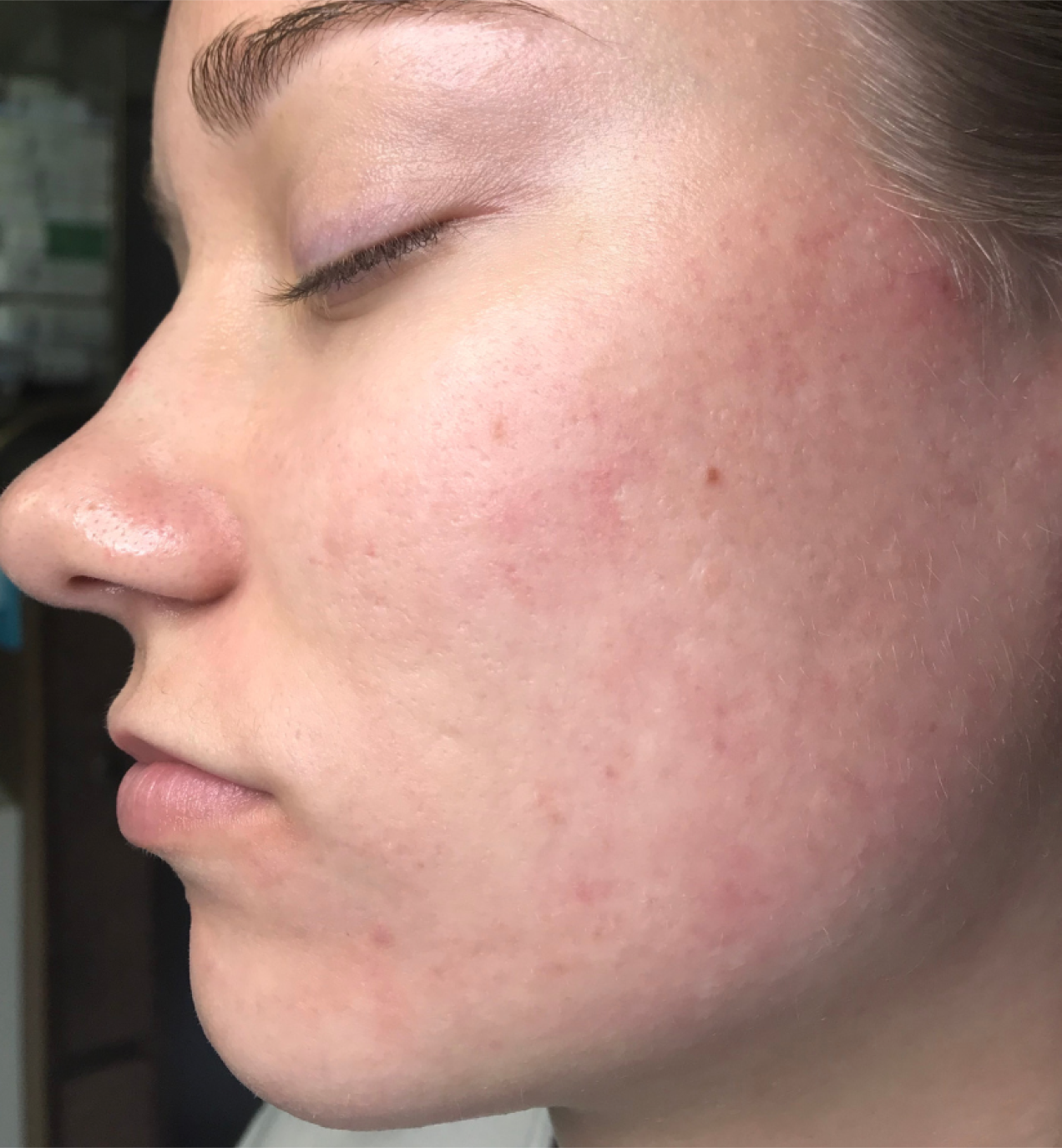 Skin Plus Clinical Skincare | Science-Driven Acne Solutions – Skin+